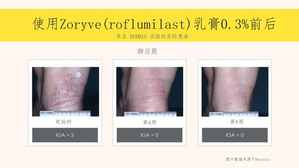 斑块型银屑病新药！FDA批准无类固醇乳膏Zoryve(roflumilast)0.3% - 知乎