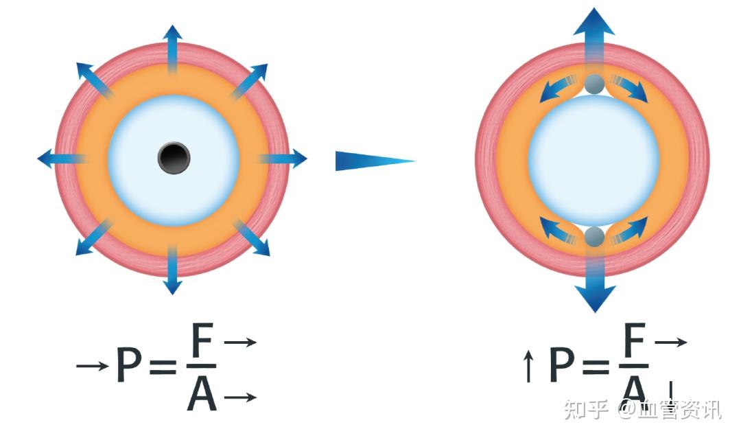 双导丝球囊之四两拨千斤 - 知乎