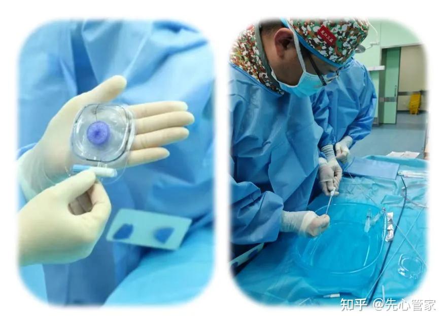 呼伦贝尔市首例MemoSorb®(生物可降解卵圆孔未闭封堵器)植入术在扎兰屯市中蒙医院完成 - 知乎