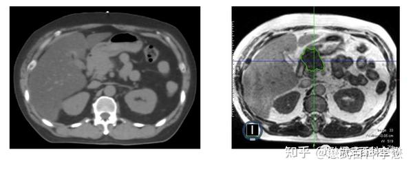 MRIdian Linac 磁共振引导放疗系统介绍 - 知乎