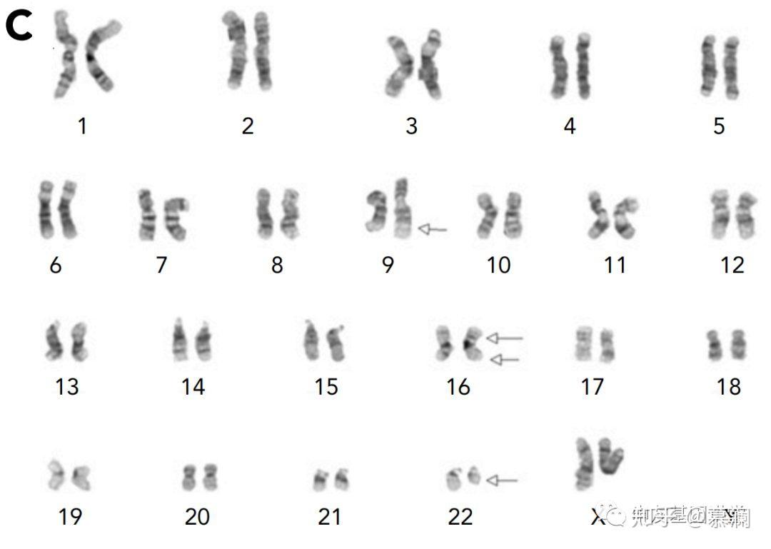 罕见病例，急性髓系白血病并存t(9;22)和 inv(16)！ - 知乎