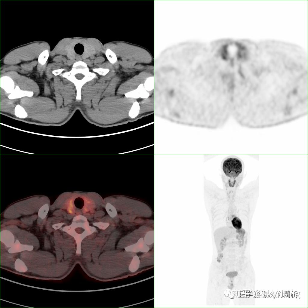 PET/CT+MR多模态检查对于甲状腺病变良恶性鉴别的诊断价值 - 知乎