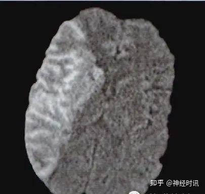 【推荐】大脑前、中、后动脉区梗死总结 - 知乎