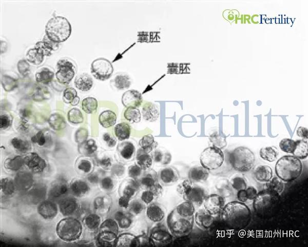 HRC课堂 | 胚胎等级 vs PGS/PGD，哪个才是衡量胚胎移植的最佳标准？ - 知乎
