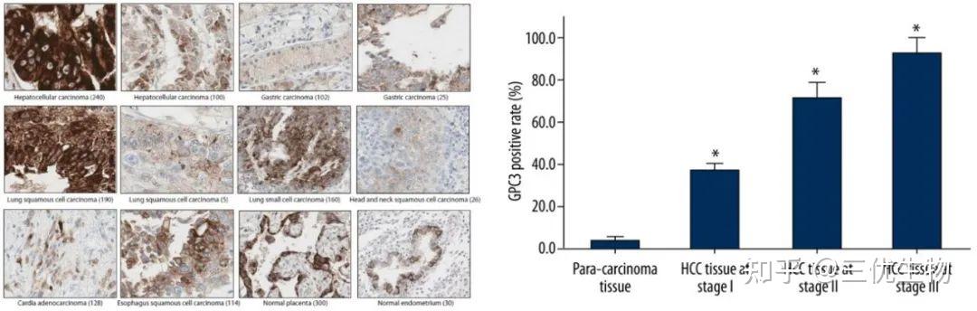 三优药讯｜GPC3 CAR-T细胞联合索拉非尼，肿瘤病灶完全消失 - 知乎