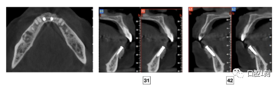 Sticky Bone在引导骨再生中的应用 - 知乎