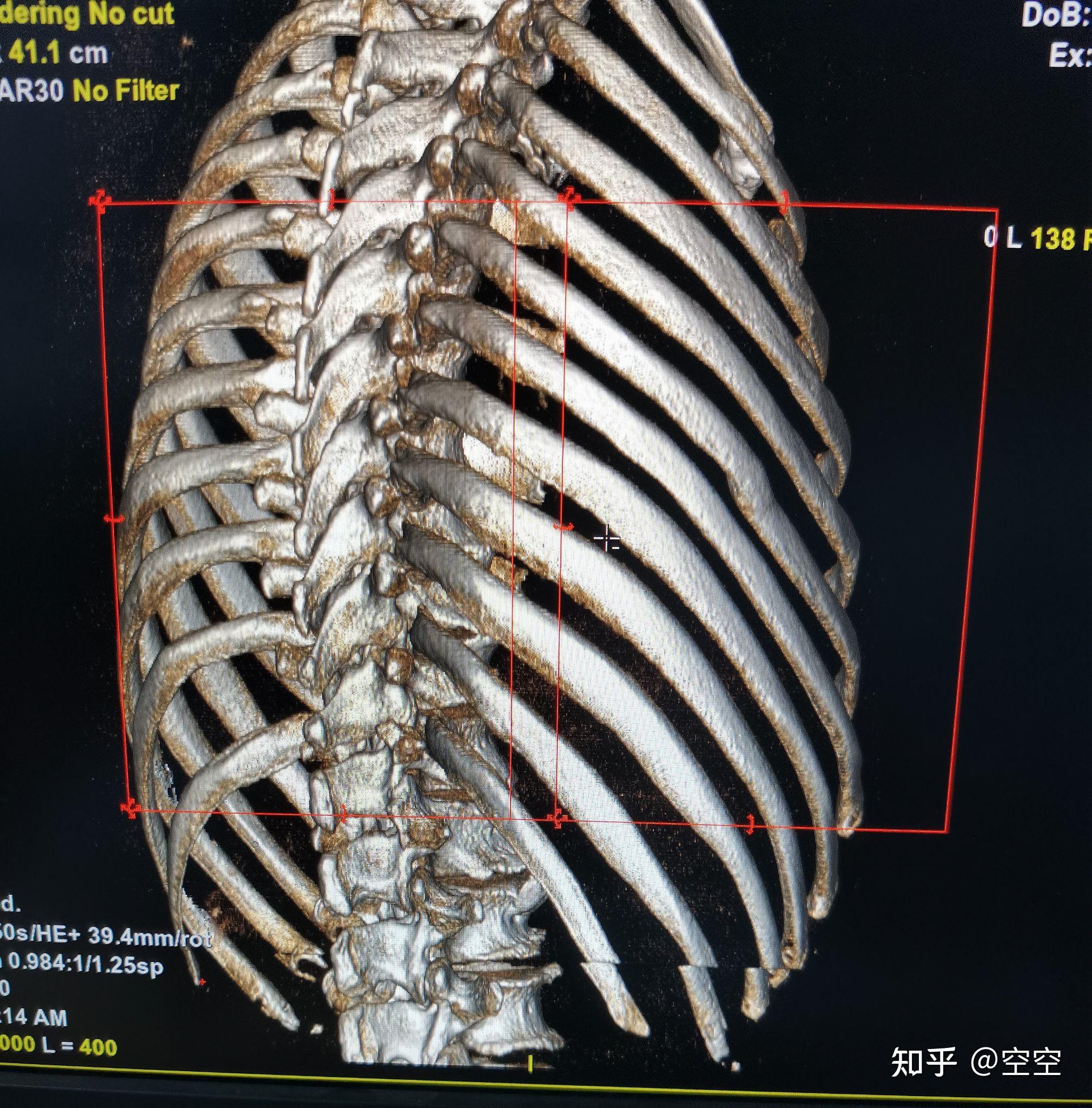 胸部CT重建VR图像错层还是骨折？ - 知乎