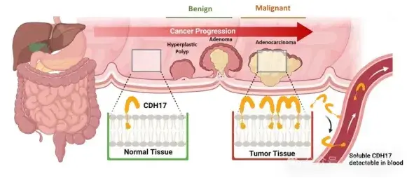 胃肠道肿瘤治疗“黄金赛道” CDH17 - 知乎