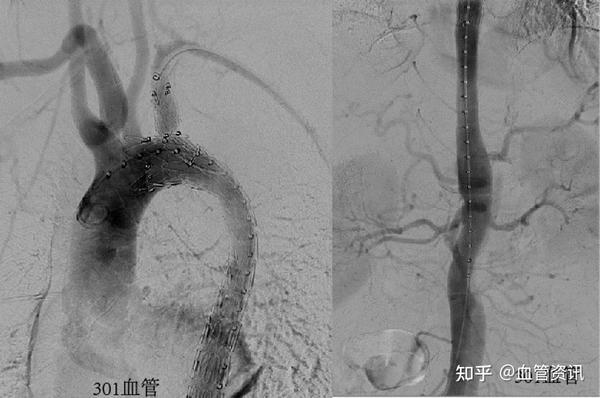 WeFlow-Tbranch单内嵌分支胸主动脉覆膜支架系统临床试验随访结果 - 知乎