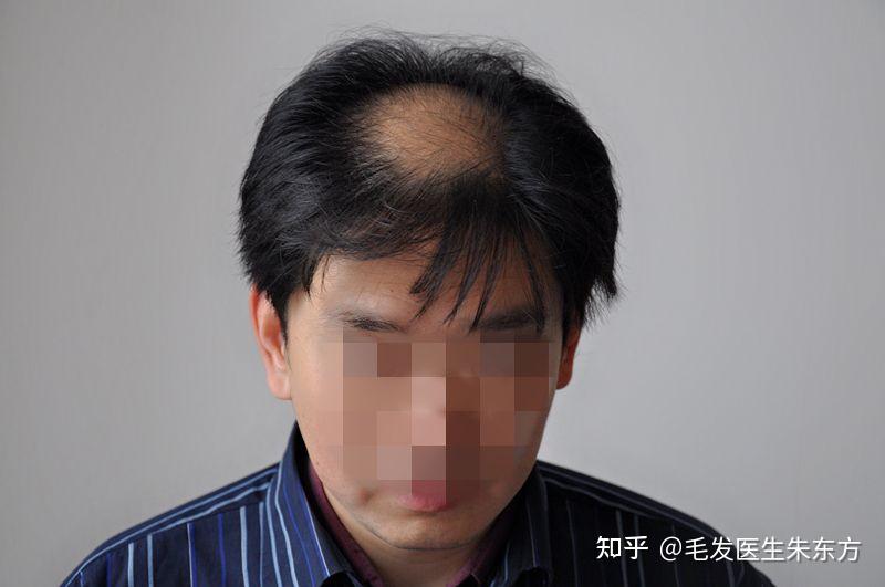 头顶头发稀疏该如何挽救？ 知乎