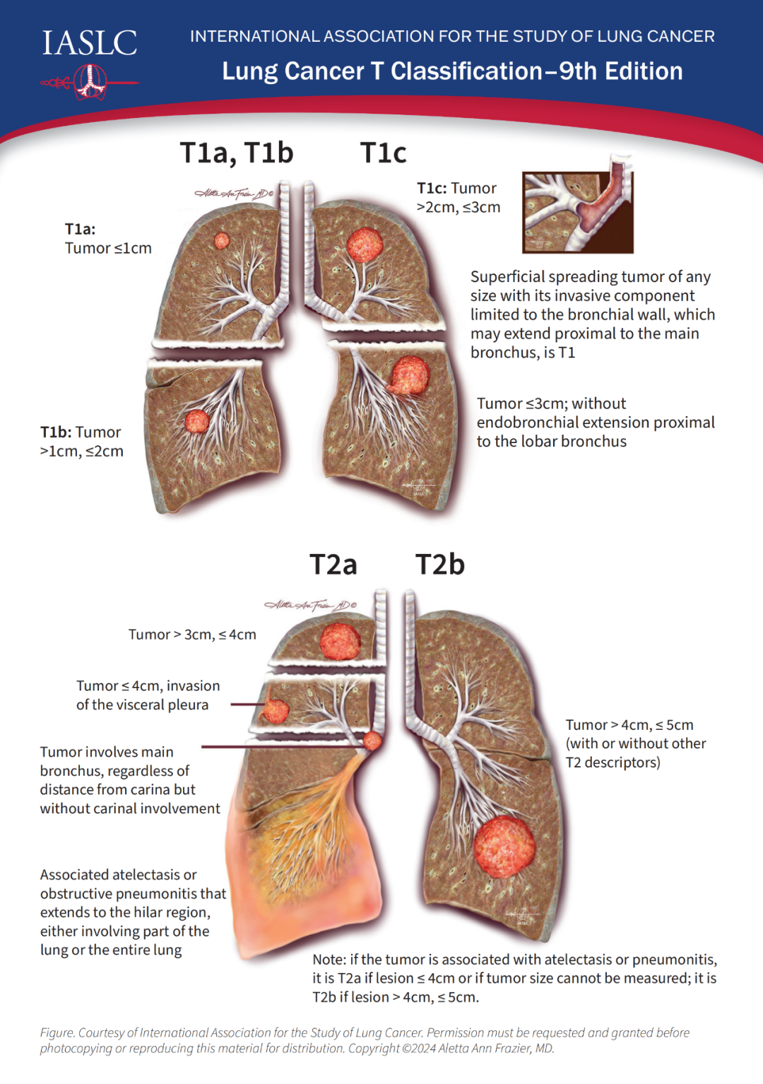 第九版肺癌TNM分期系统 - 知乎