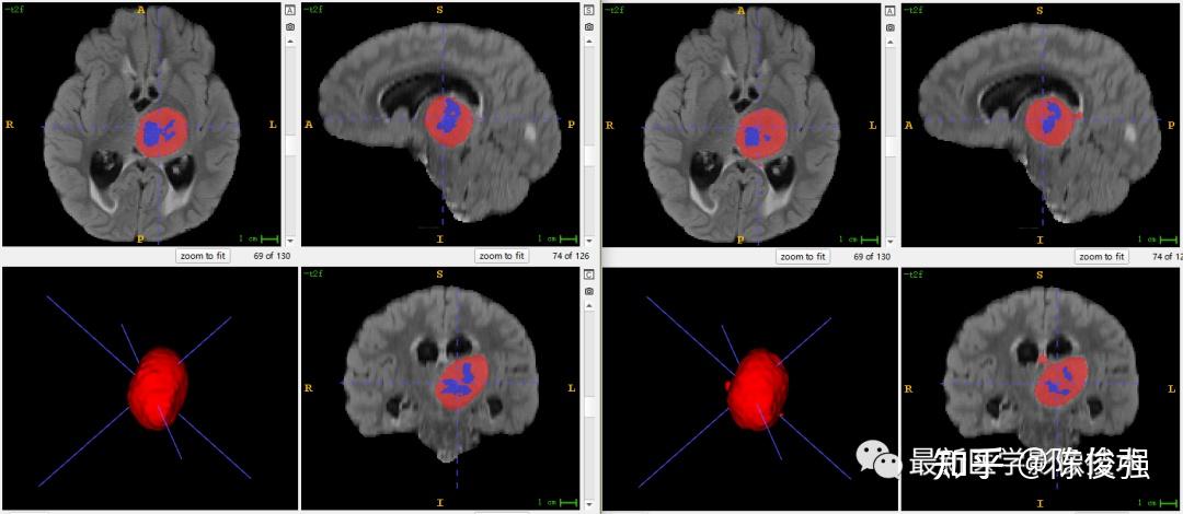 BraTS2023-PED——BraTS2023儿科肿瘤分割挑战赛 - 知乎