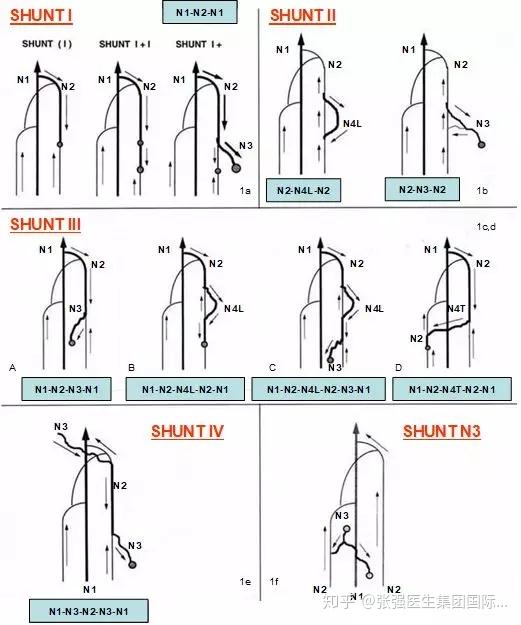 里程碑 | 亚洲首次发布静脉曲张CHIVA诊疗共识 - 知乎