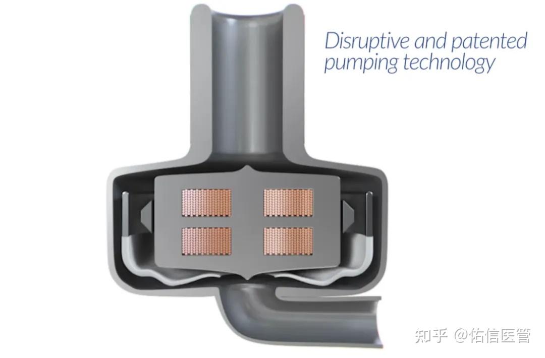 全球首植！基于独特波浪膜技术的左心室辅助装置 - 知乎
