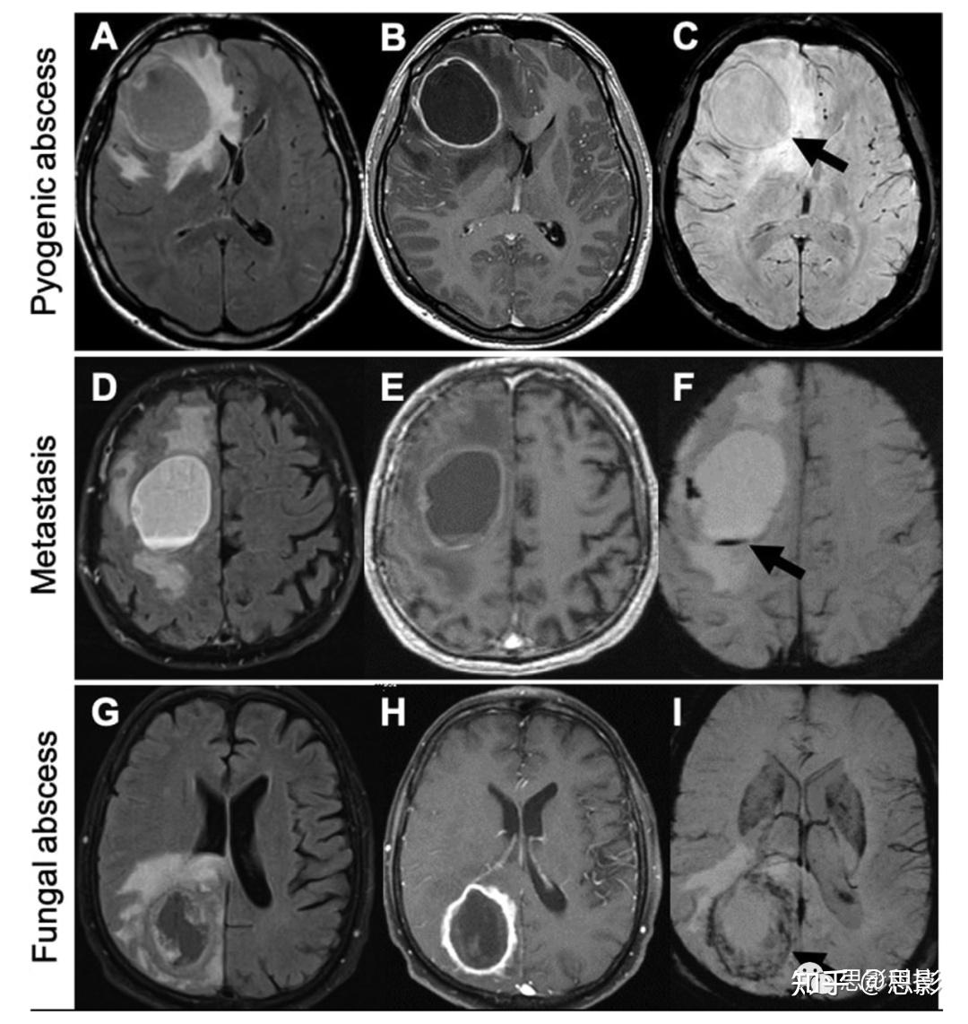 磁敏感加权成像（SWI)：技术要点和临床神经学应用 - 知乎