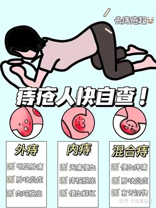 痔疮｜为什么有的痔疮痛？不痛的痔疮还用治疗吗？ 知乎 7340