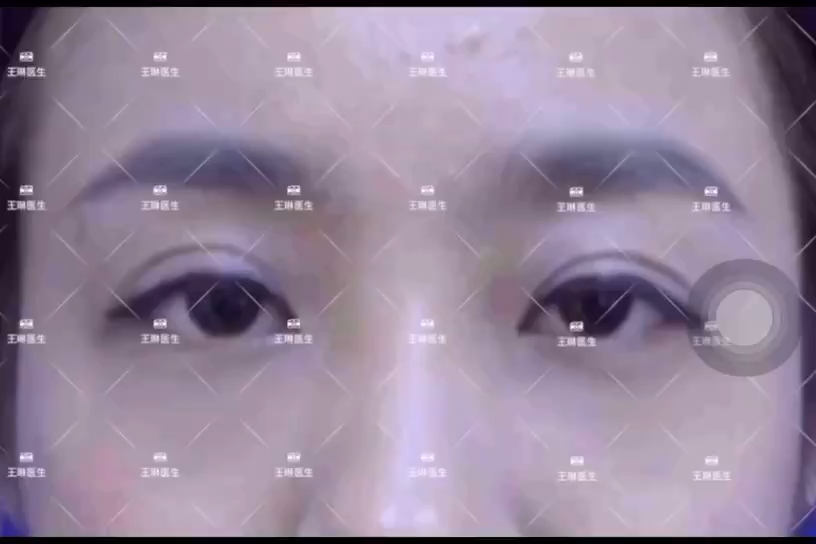 大连日报专访：年纪大了眼睛老睁不开，是怎么回事 知乎