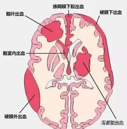 新生儿颅内出血，你了解吗？ 知乎