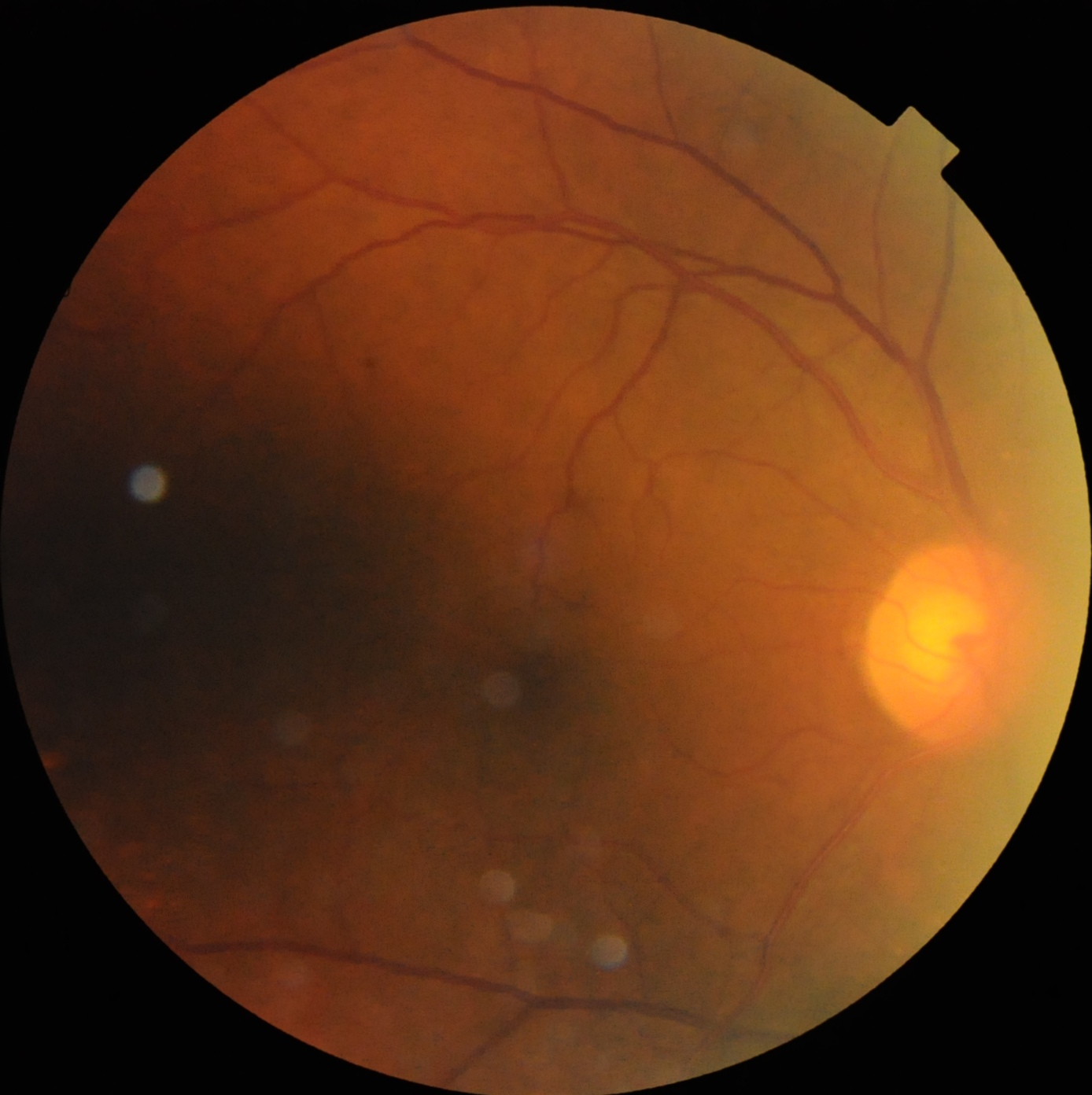 Multi-Label Retinal Diseases视网膜眼底图像分类数据集介绍 - 知乎