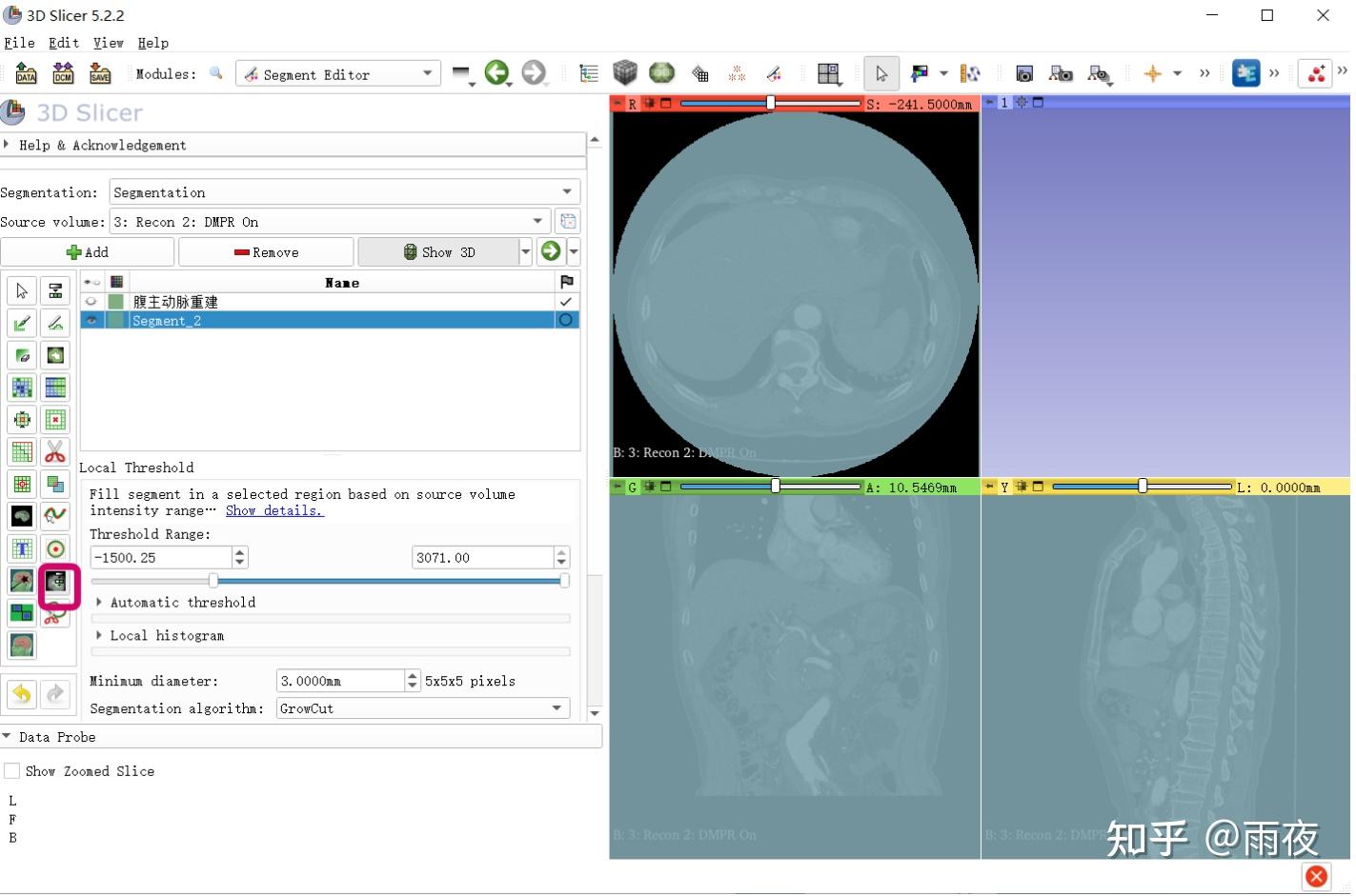 3D slicer 重建腹主动脉及髂动脉 - 知乎