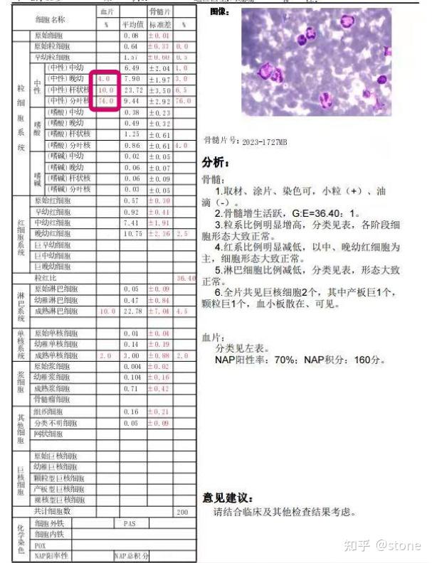 202308070909-M53-WBC高、PLT高/脾大-Mf - 知乎