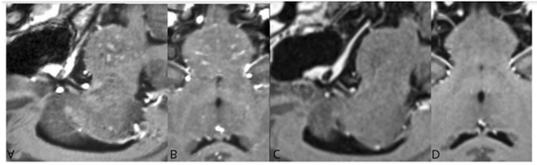 难倒大部分神内医生的MOG抗体病，8大临床表型一文掌握 - 知乎