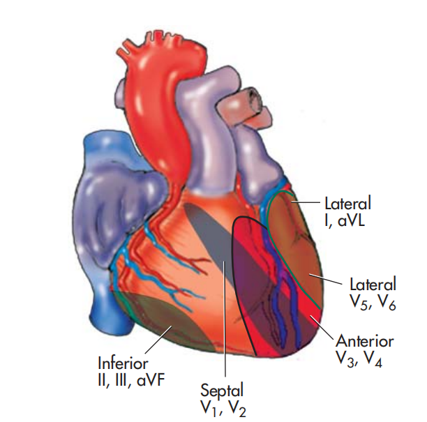 通过心电图定位心肌梗死患者受损的心肌以及受损的冠状动脉 - 知乎