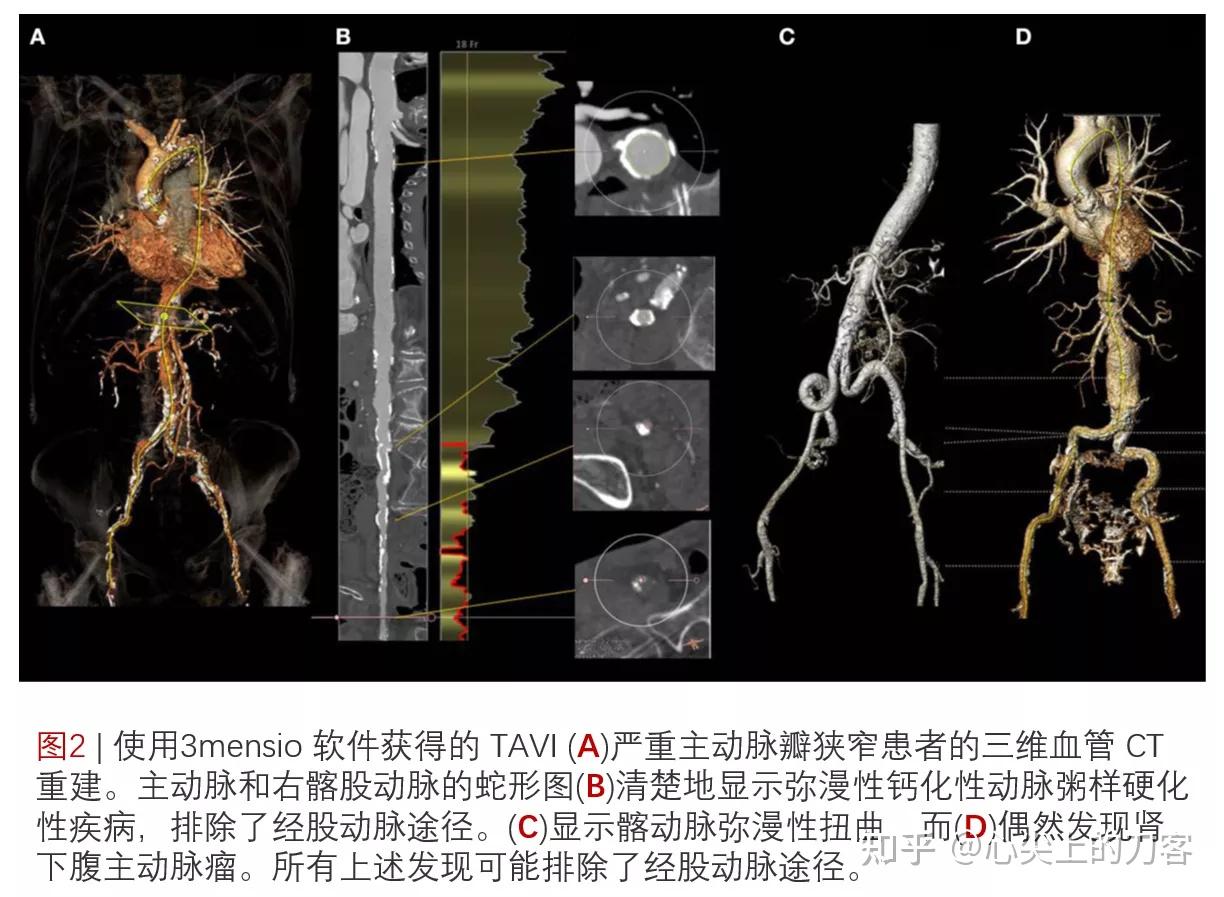 TAVI的入路问题。从哪里进？适合哪些人？ - 知乎