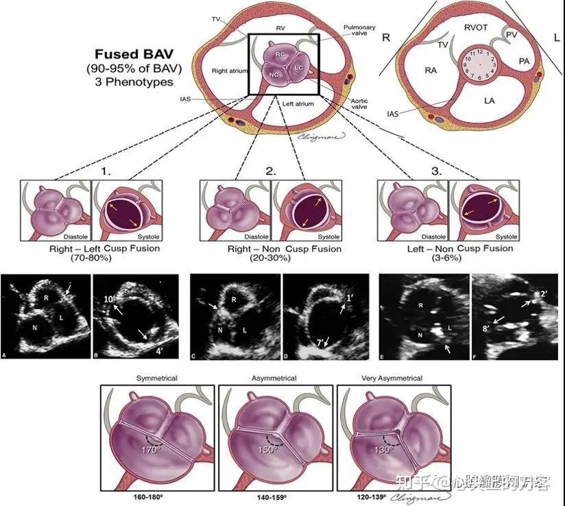 二叶式主动脉瓣畸形之一 分型 - 知乎