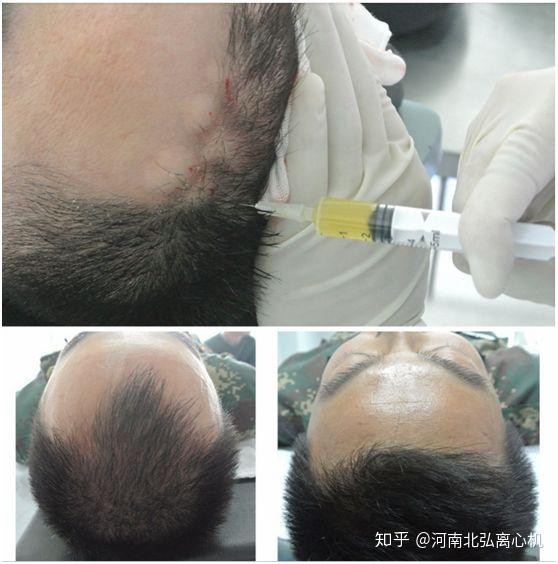 cgf与prp疗效对比 - 知乎