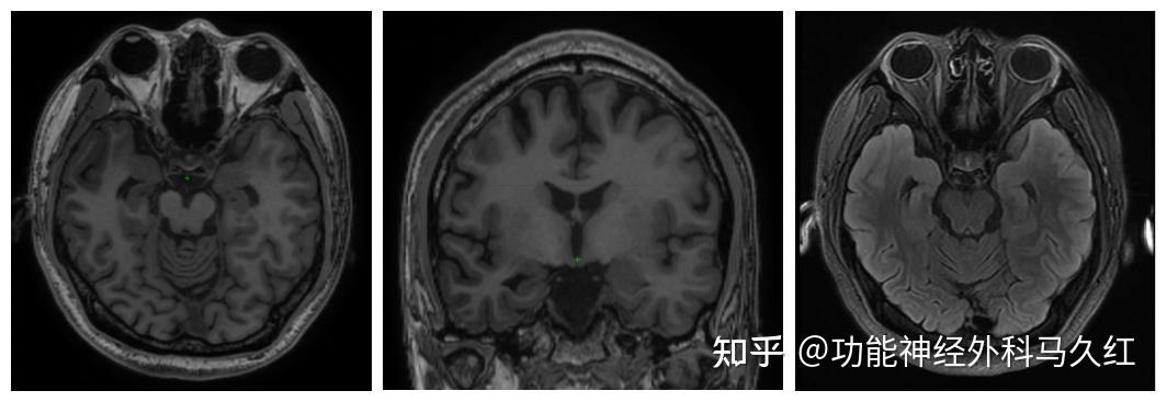 【病友故事】ROSA机器人辅助SEEG手术精准治疗造福癫痫患者 - 知乎