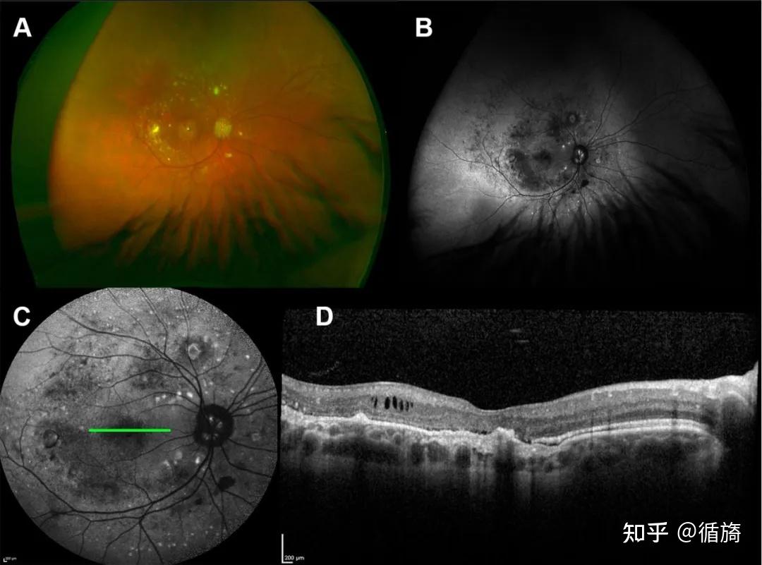 BEST1基因变异引起的黄斑营养不良征-卵黄蛋白病BVMD、AVMD、ARB、ADVIRC、RP - 知乎