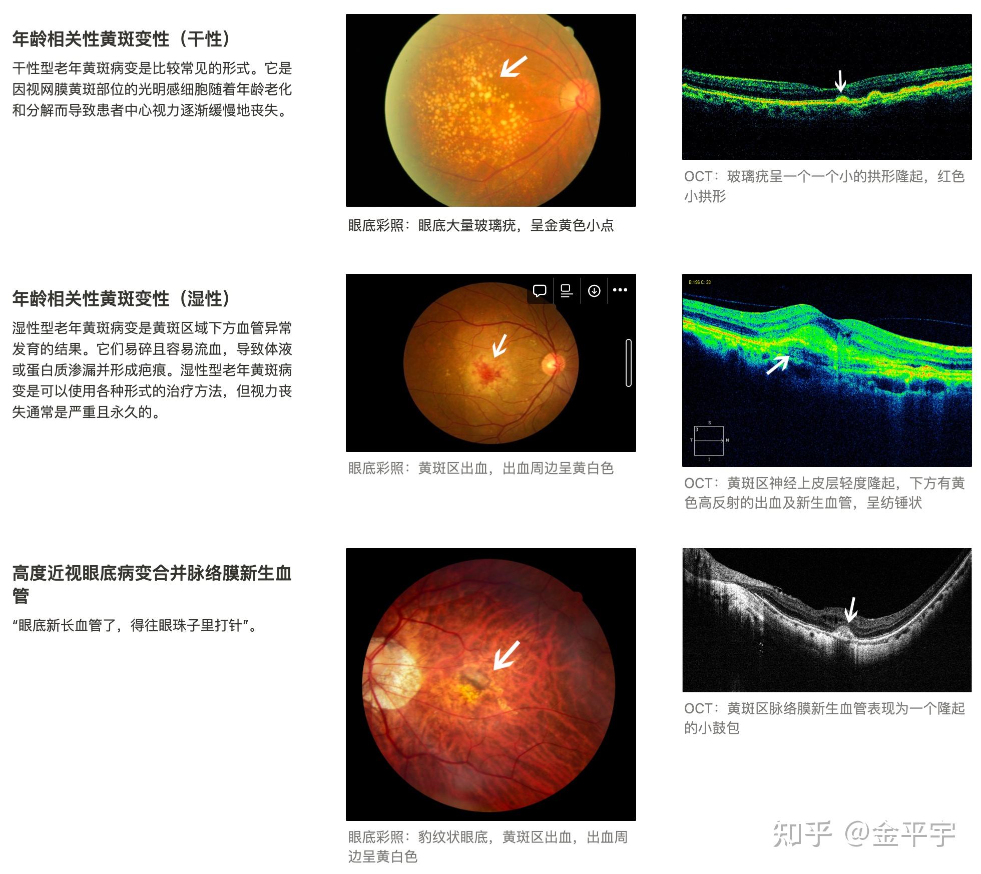 抗VEGF药物在眼底疾病治疗中的市场机遇与挑战 - 知乎