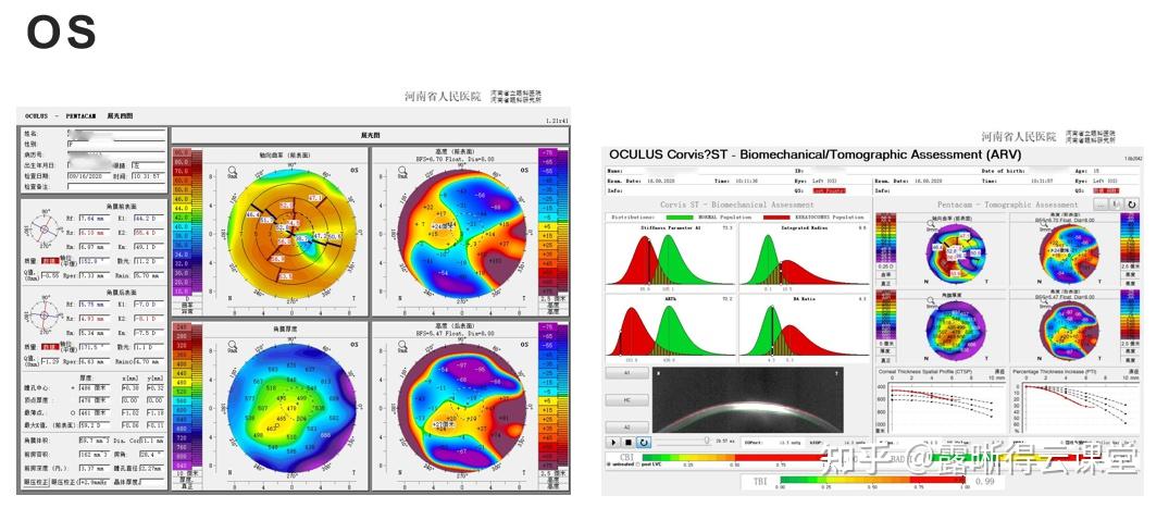 圆锥角膜的RGP验配及RGP临床效果分析（文字版） - 知乎