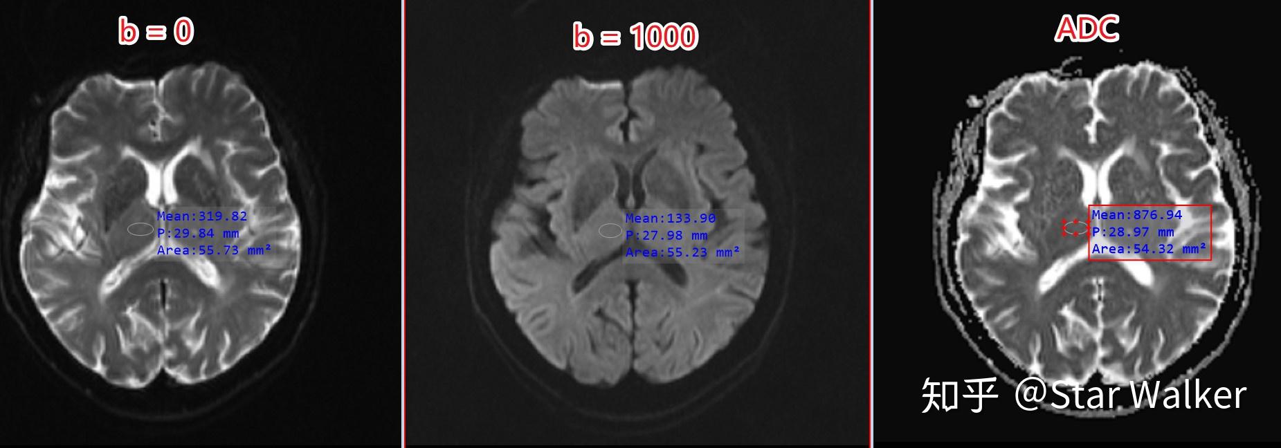 MRI ADC值是怎么来的？咱们来手算一下 - 知乎