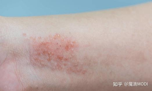 魔滴学堂:引起乳房发痒的6个原因,最后一个一定要小心了! 知乎