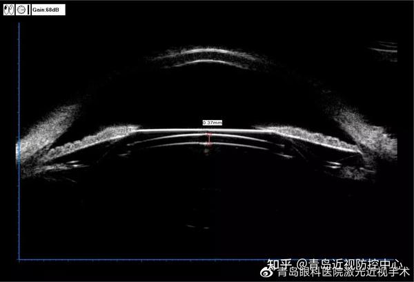 ICL晶体植入术前和术后要做哪些检查？一次说明白 - 知乎