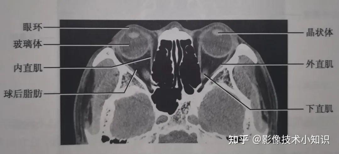 眼的CT解剖 - 知乎