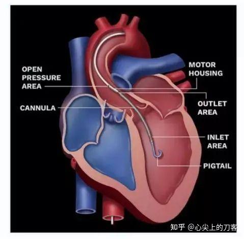 心衰治疗的黑科技——左室辅助装置 - 知乎