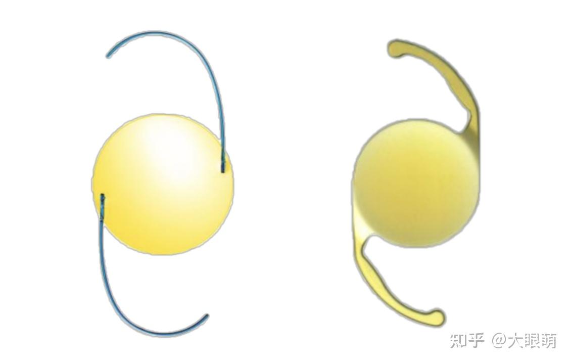 人工晶状体（后房型） - 知乎