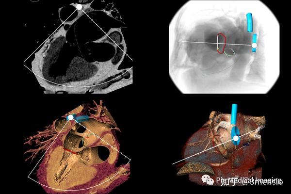 3mensio Mitral - 知乎