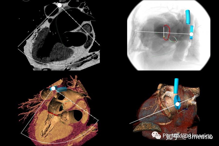 3mensio Mitral - 知乎