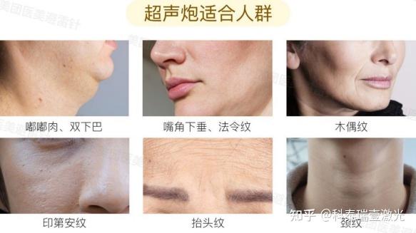 什么样的人适合做超声炮?避坑指南! 知乎