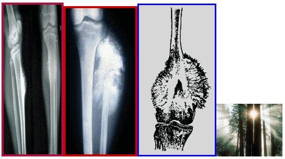 第四十八章 骨肿瘤病人的护理 - 知乎