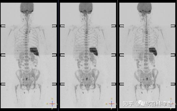 磁共振序列之DWIBS - 知乎