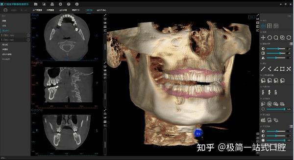 CBCT在数字化口腔诊疗中的巨大优势 - 知乎