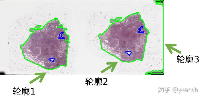 CLAM: A Deep-Learning-based Pipeline for Data Efficient and Weakly Supervised Whole-Slide-level ...