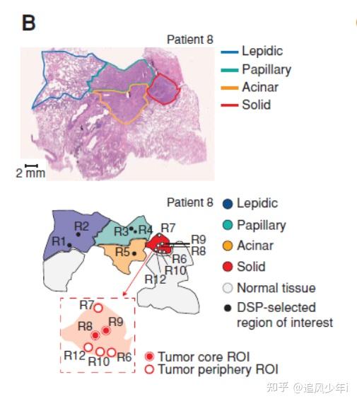 单细胞 & DSP(Digital Spatial Profiler)联合分析解析肺腺癌的转录重编程推动cancer evolution - 知乎