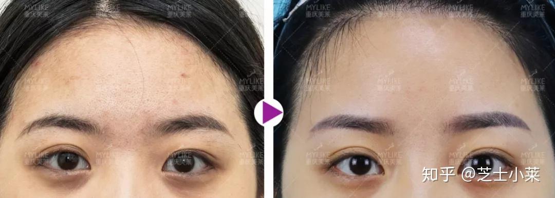 水光针和光子嫩肤的区别是什么?该如何选择呢? 知乎