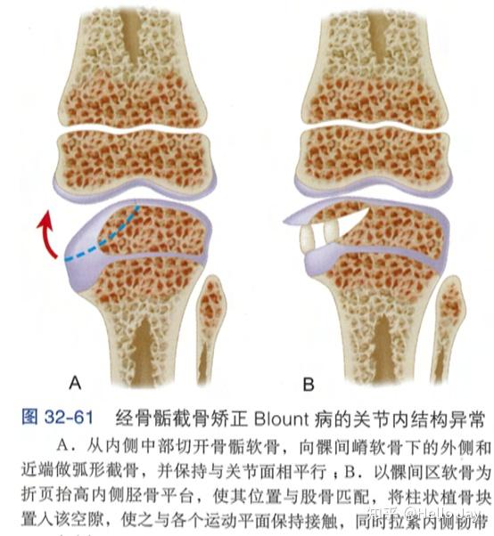 胫骨内翻（Blount病） - 知乎
